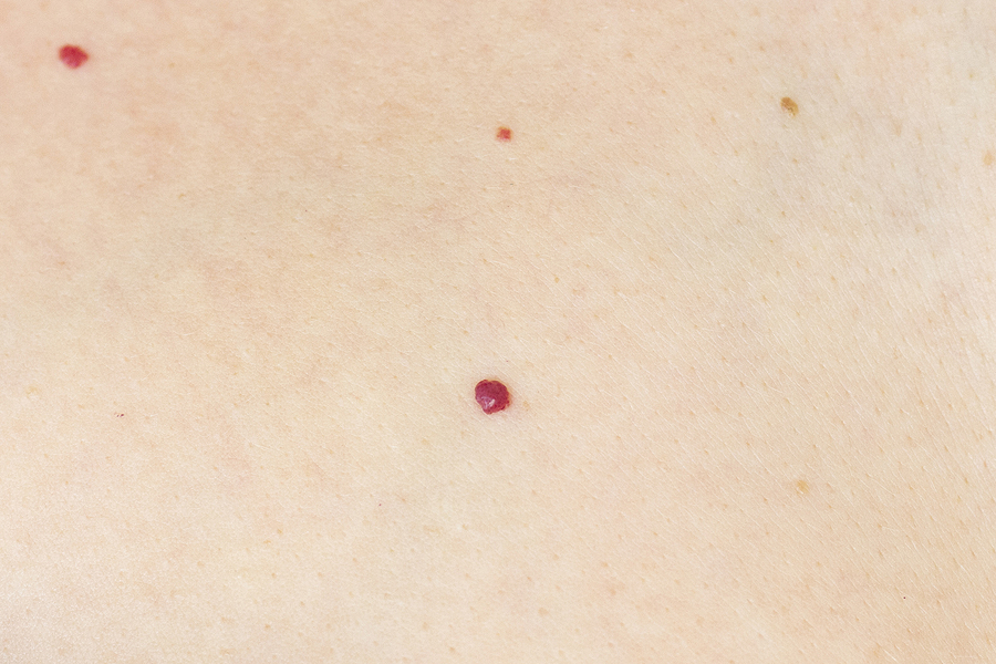 Red Spot Treatment - One Dermatology